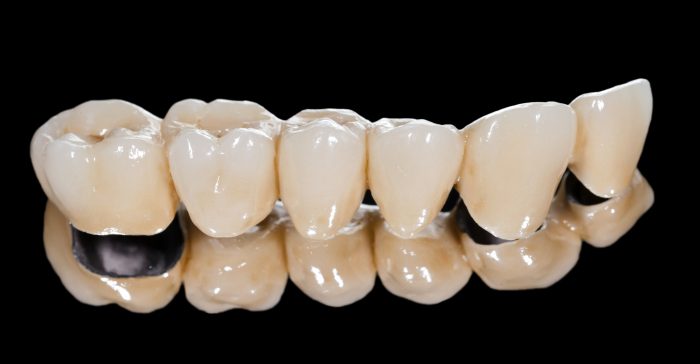 Bridgework : Aspire Family Dental